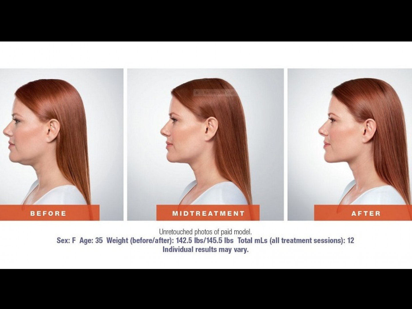 Kybella Injections | DeRidder & Moss Bluff, LA | Vivid McCann Wellness ...